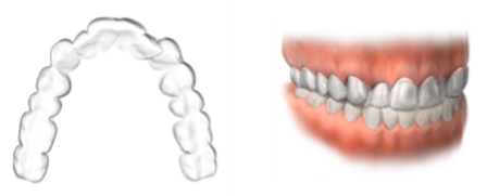 Orthodontic Appliances - Christenson Family Orthodontics